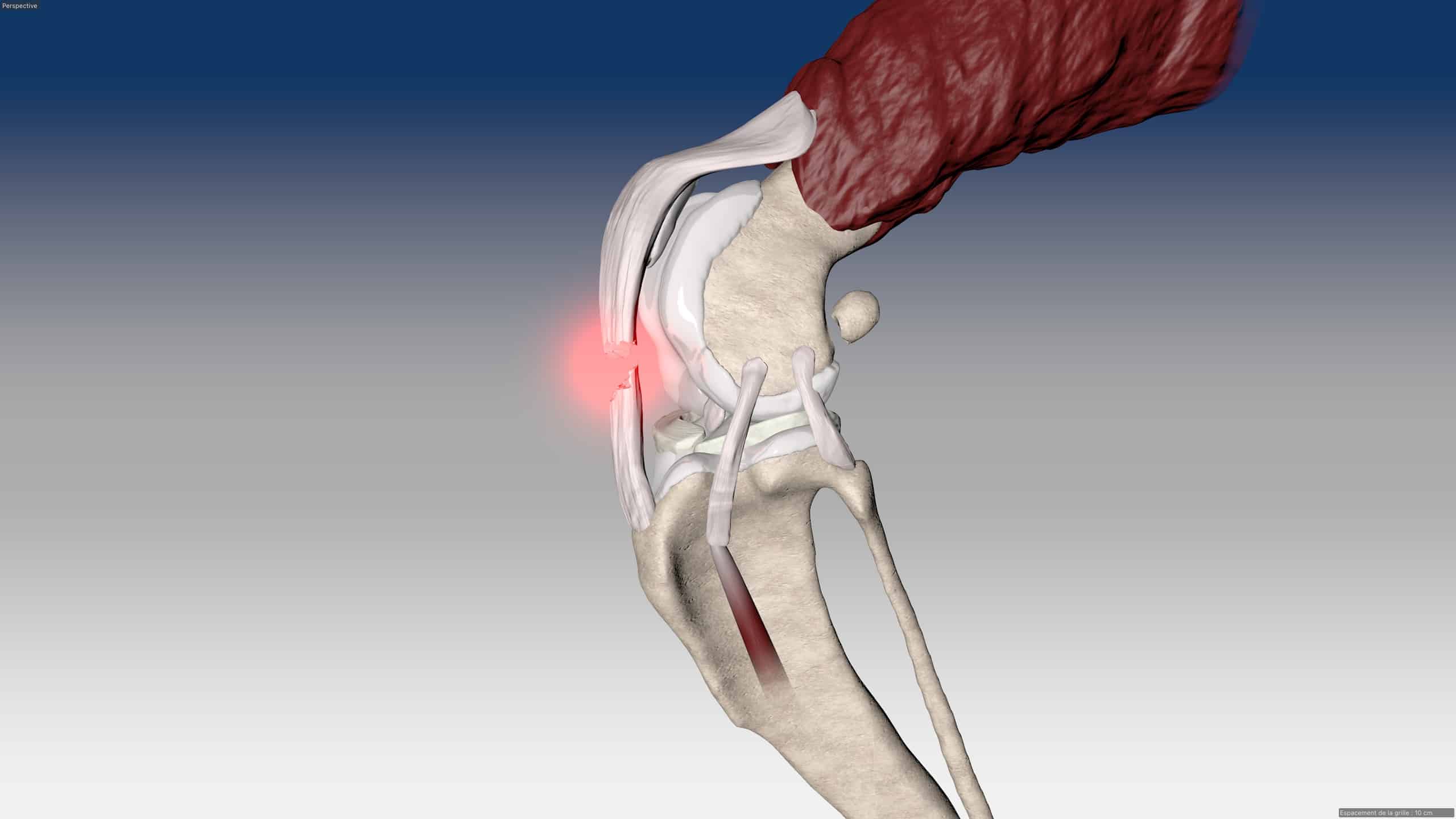 Patellar Tendon Repair