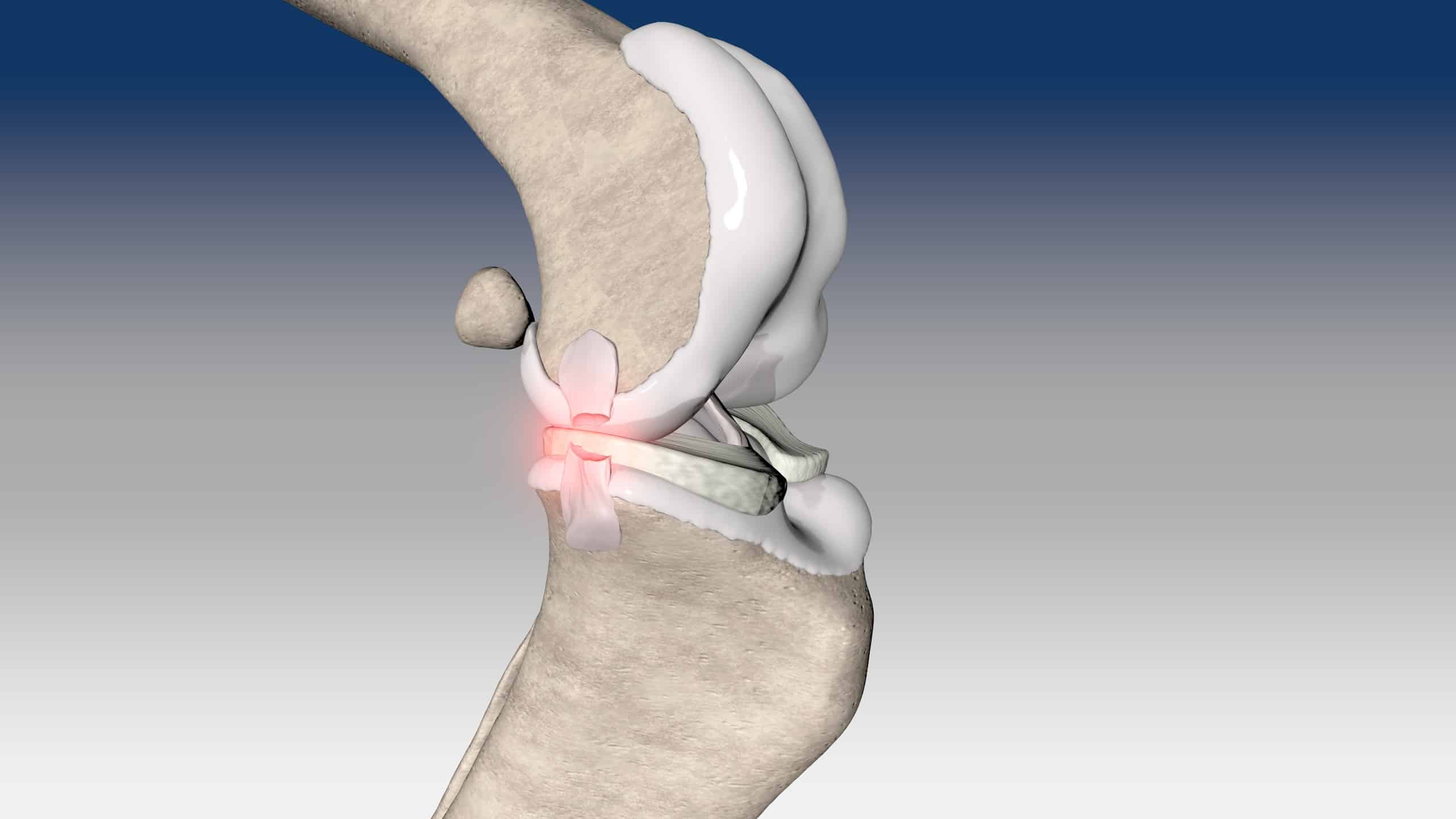 Knee medial collateral ligament reconstruction - Novetech Surgery