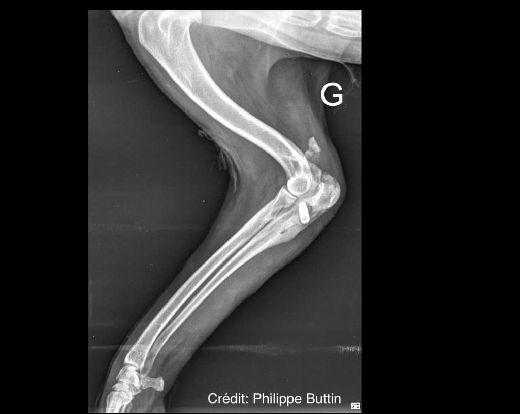 Reconstruction du tendon du triceps - Novetech Surgery