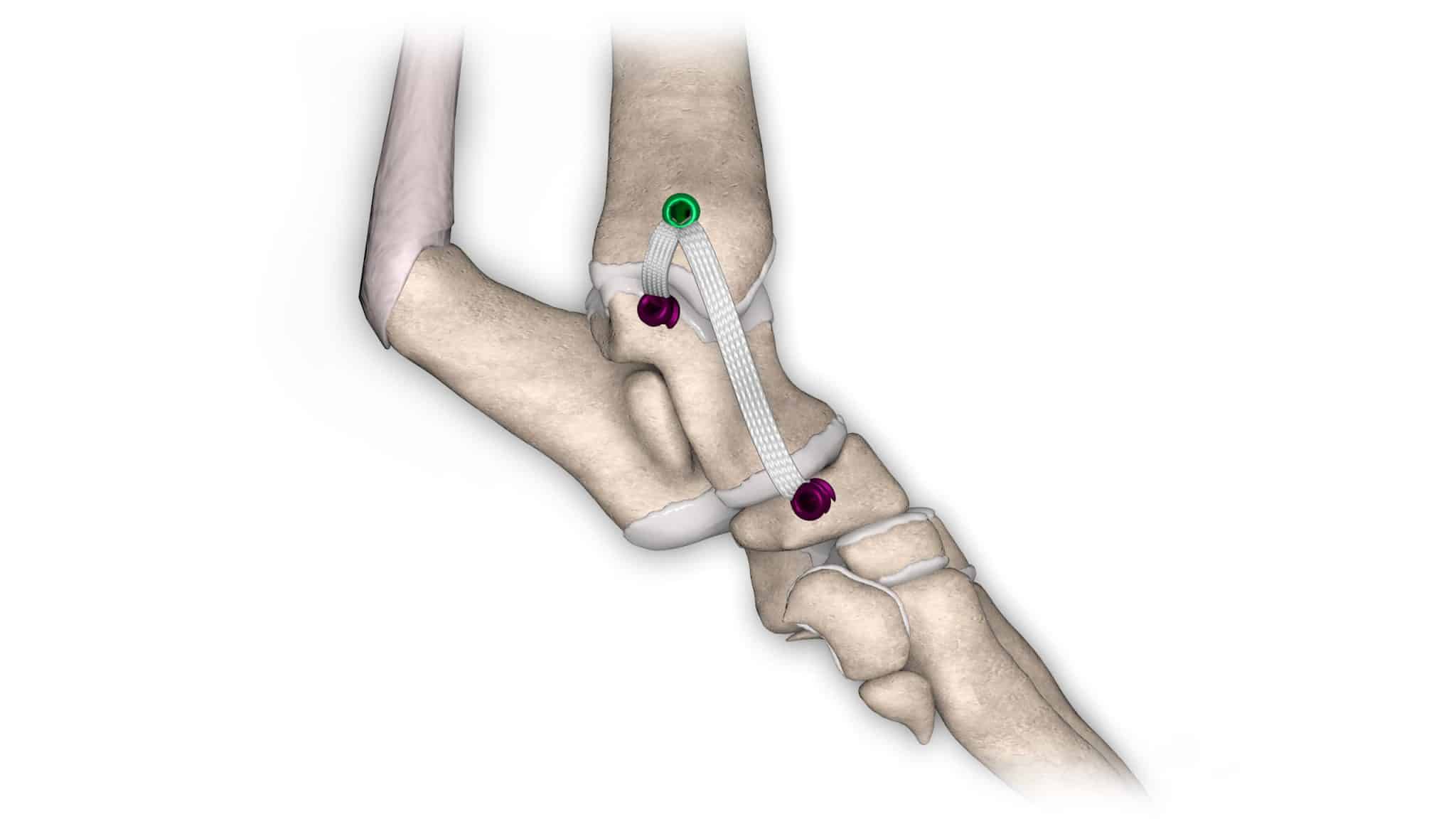 Reconstruction of tarsal medial collateral ligament - Novetech Surgery