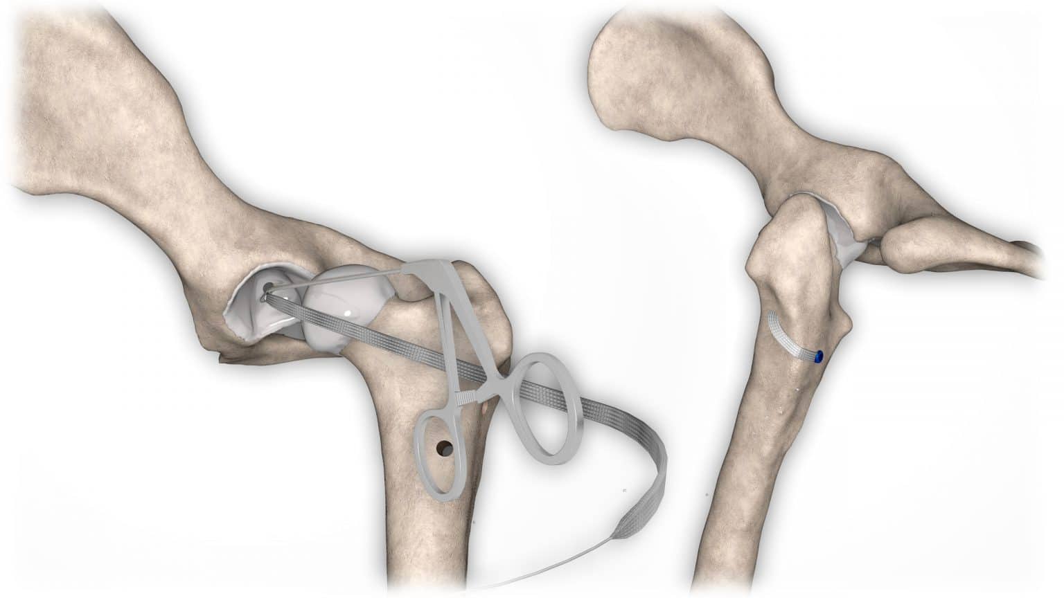 Hip dislocation : Round ligament reconstruction - Novetech Surgery