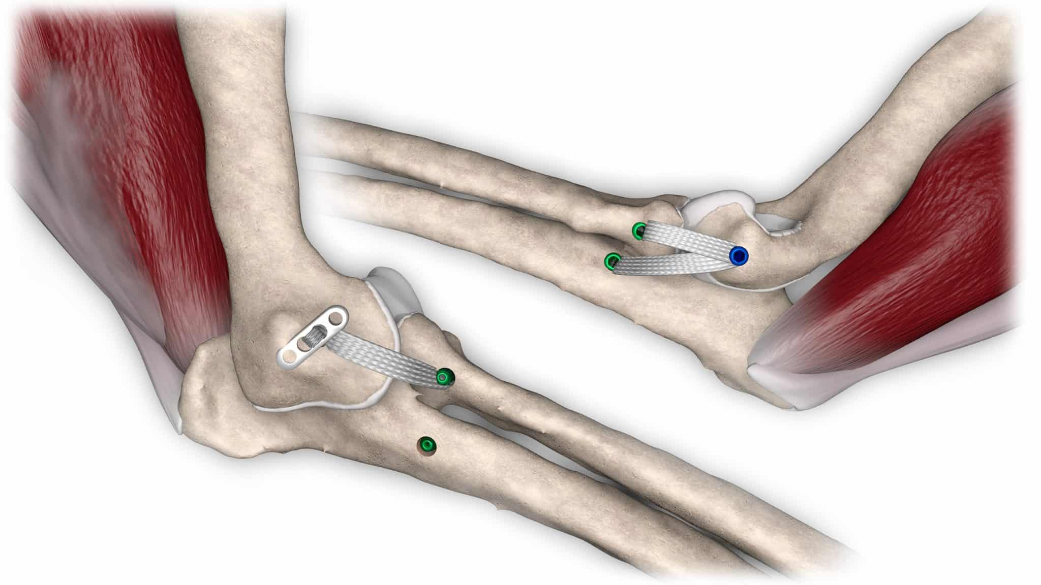Stabilization of elbow dislocation - Novetech Surgery