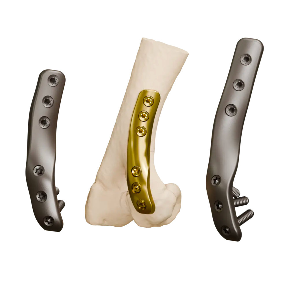 FUSION IMPLANTS – LEAP Lateral Epicondylar Anatomical Plate - Novetech ...