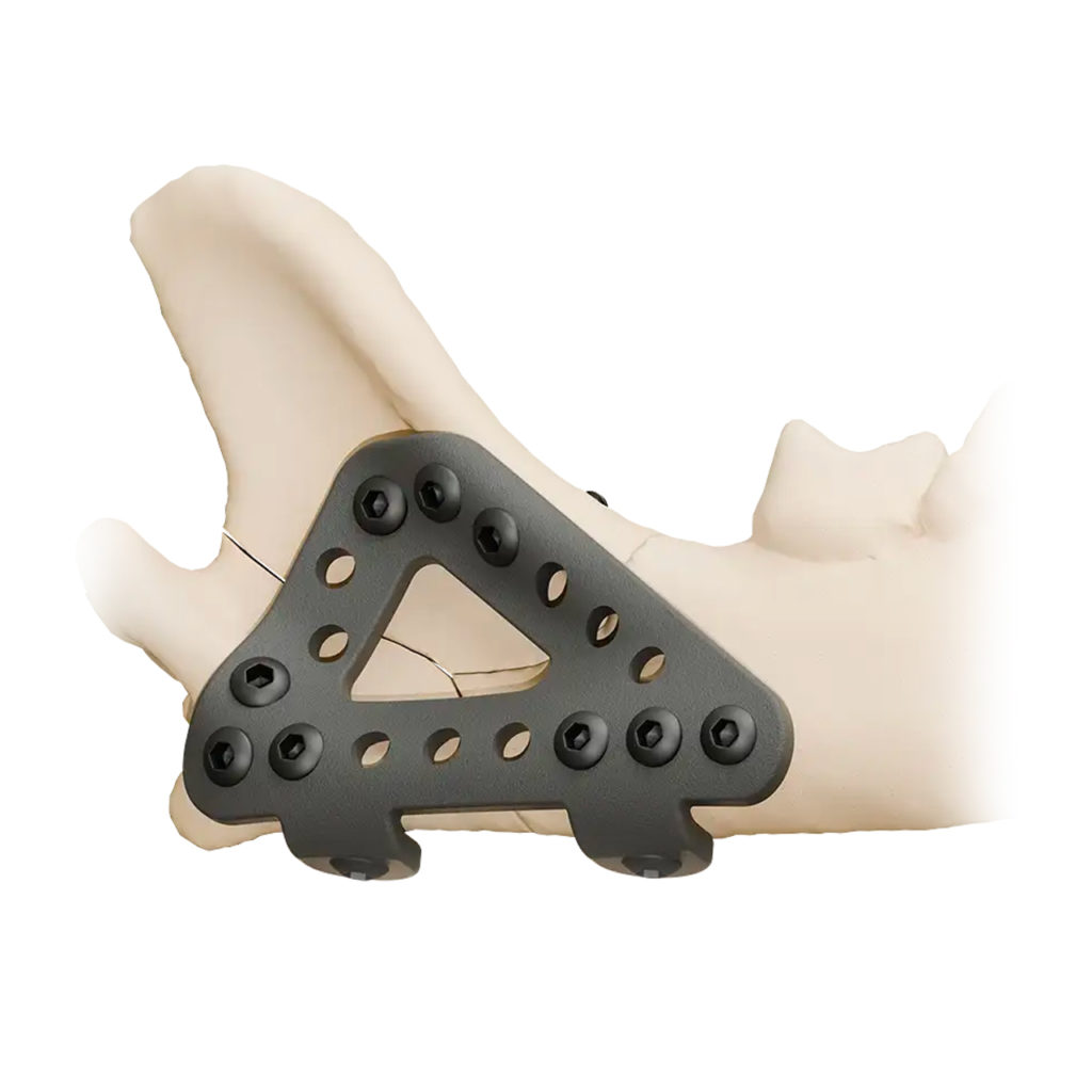 FUSION IMPLANTS – RAP - Novetech Surgery