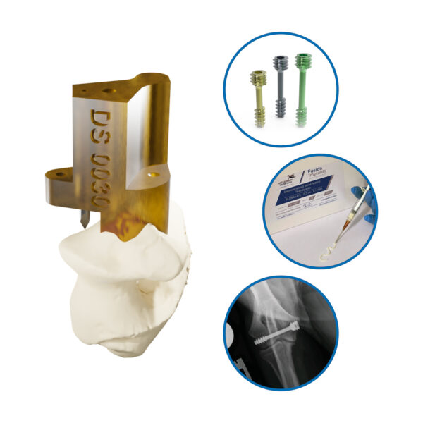 FUSION IMPLANTS – Pack HIF Guide + Screw HIRS + DBM - Novetech Surgery